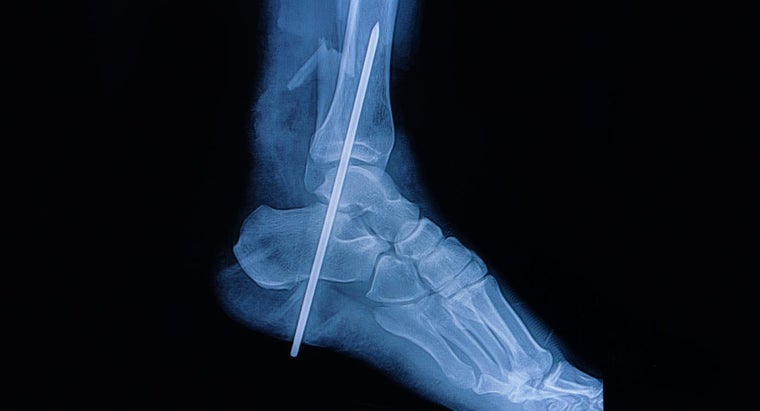 What Is the Preferred Treatment for a Fibula Fracture? | Reference.com